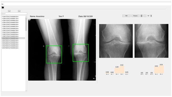 Detection and Classification of Knee Osteoarthritis
