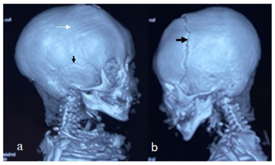 Craniofacial Malformations as Fundamental Diagnostic Tools in Syndromic ...