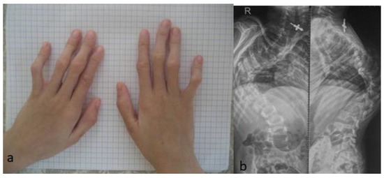 Craniofacial Malformations as Fundamental Diagnostic Tools in Syndromic ...