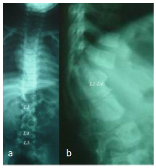 Craniofacial Malformations as Fundamental Diagnostic Tools in Syndromic ...