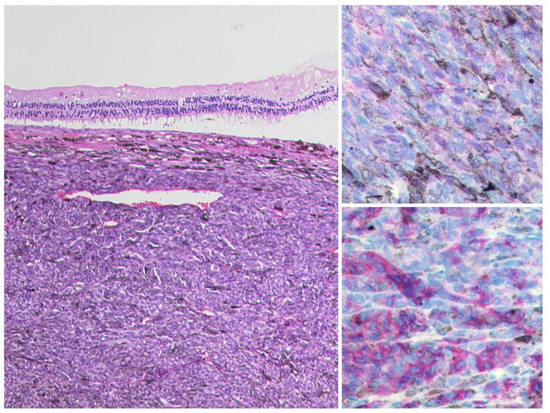 Orbital Tumors—Clinical, Radiologic and Histopathologic Correlation