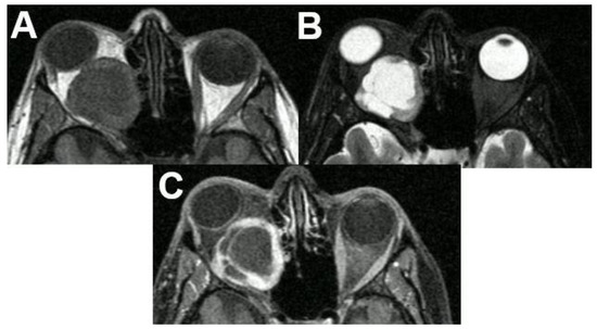 Orbital Tumors—Clinical, Radiologic and Histopathologic Correlation