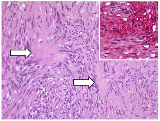 Orbital Tumors—Clinical, Radiologic and Histopathologic Correlation