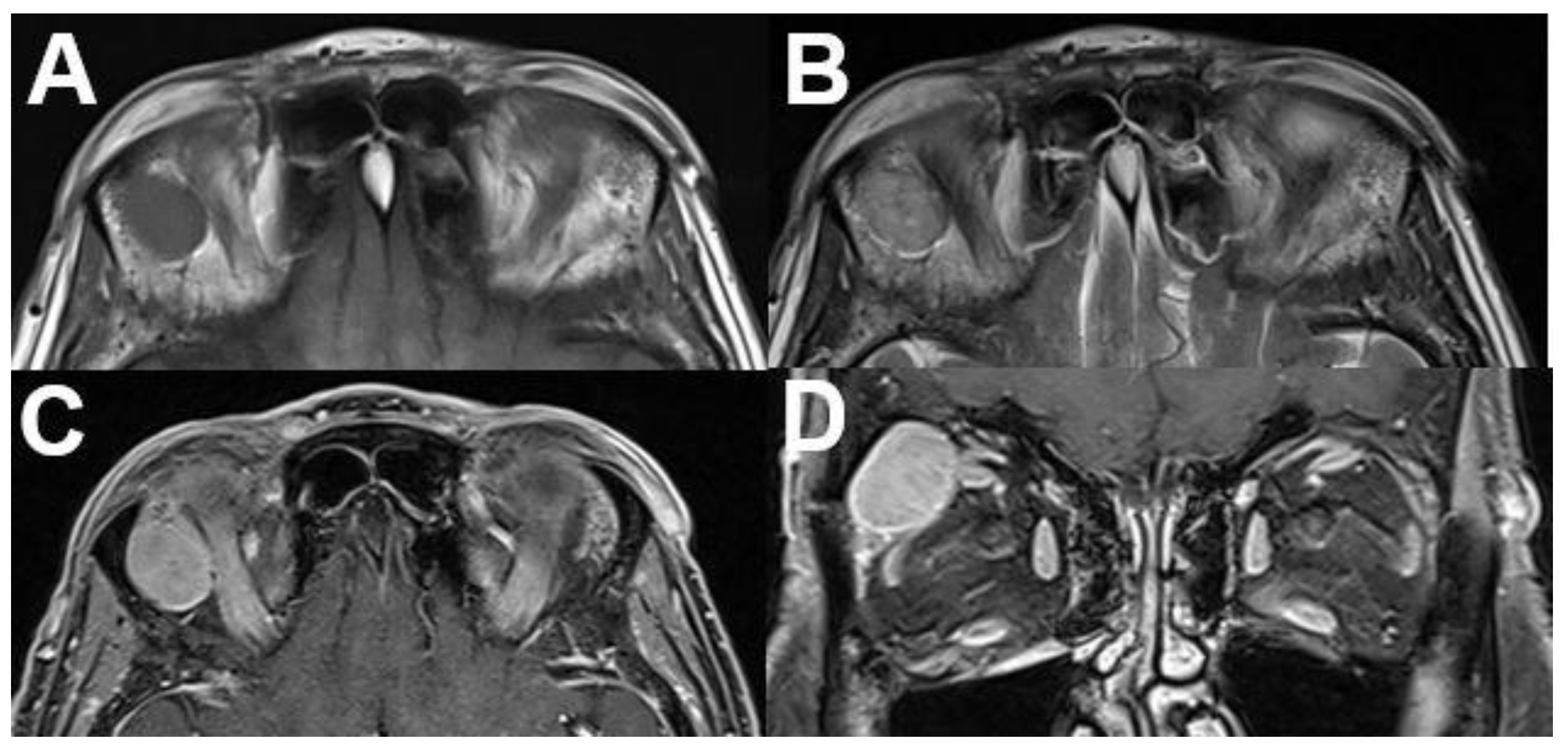 Orbit Mri Tumor