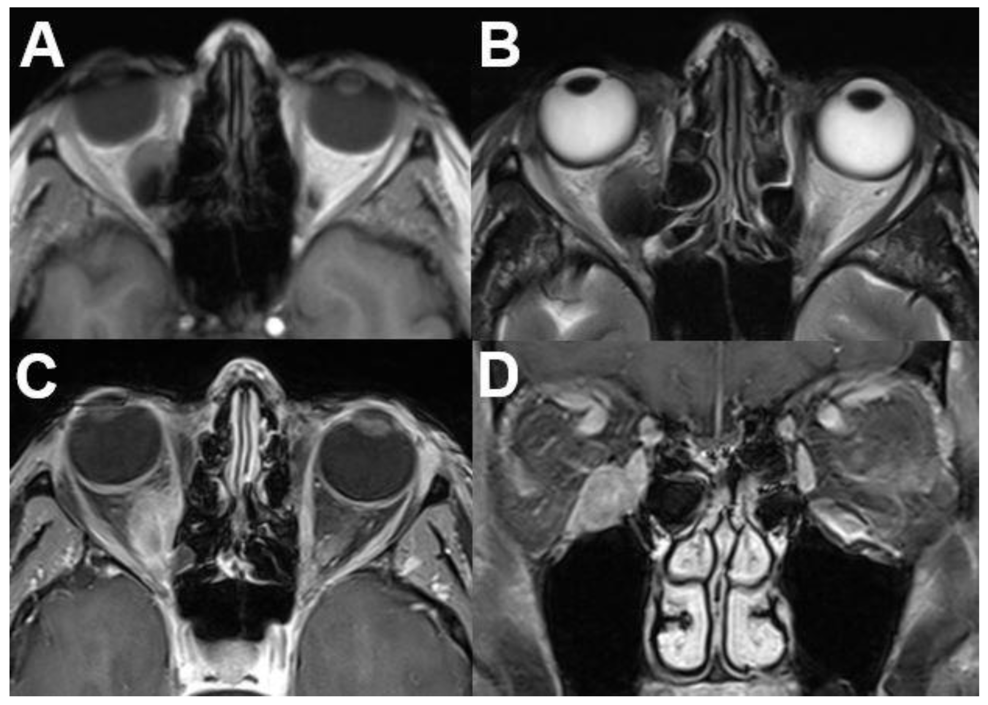 Orbit Mri Tumor