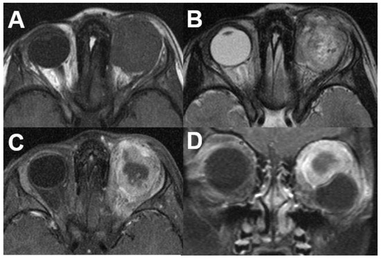 Orbital Tumors—Clinical, Radiologic and Histopathologic Correlation