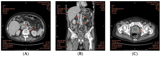 Prostate Cancer after Percutaneous Arterial Embolization of the ...