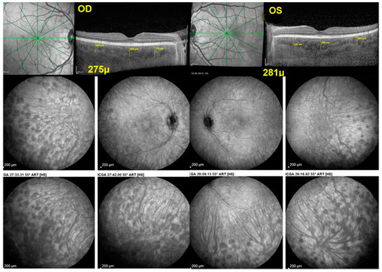 Benefits and Limitations of OCT-A in the Diagnosis and Follow-Up of ...