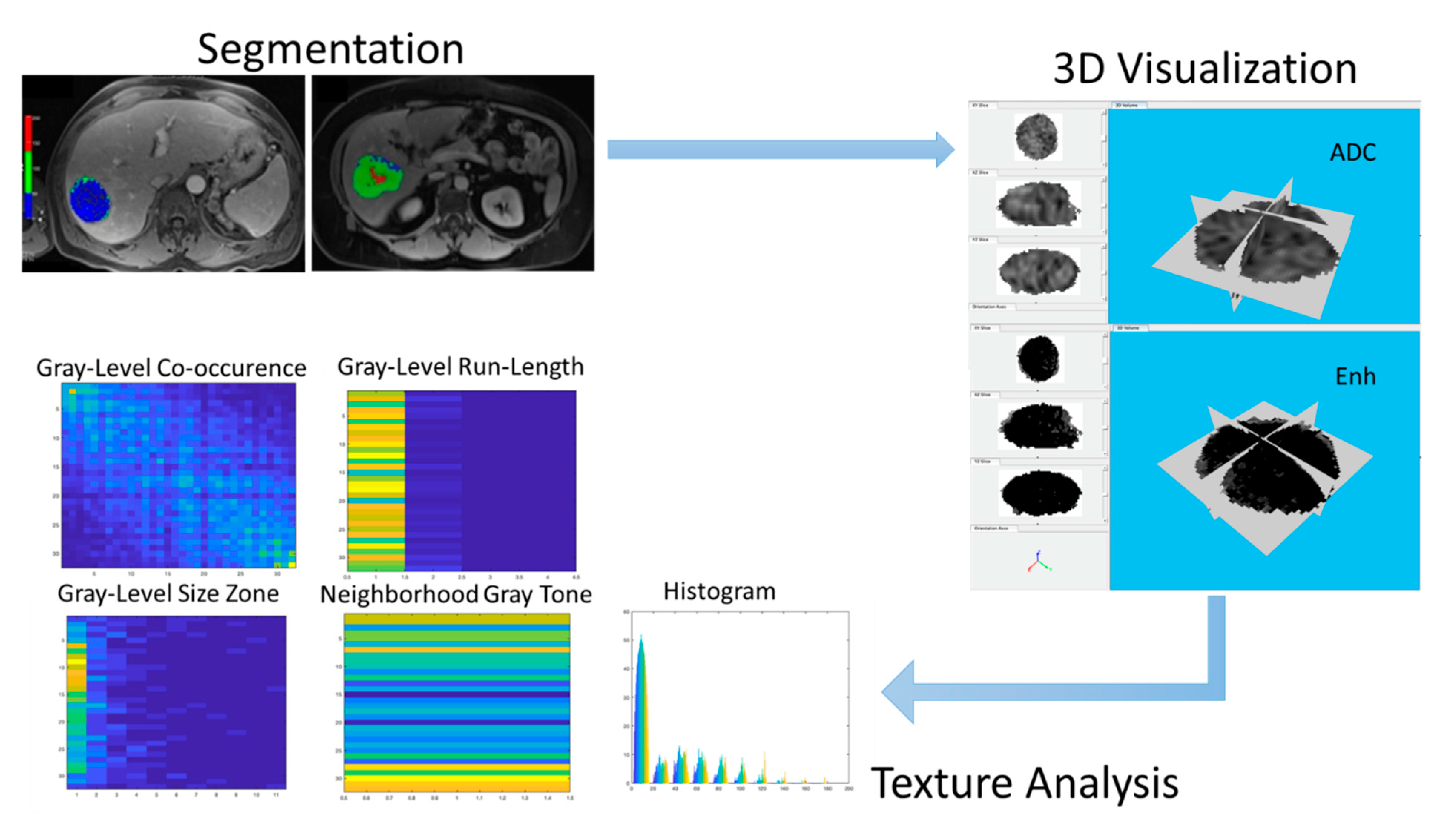 Role of MRI-Derived Radiomics Features in Determining Degree of Tumor Differentiation of ...