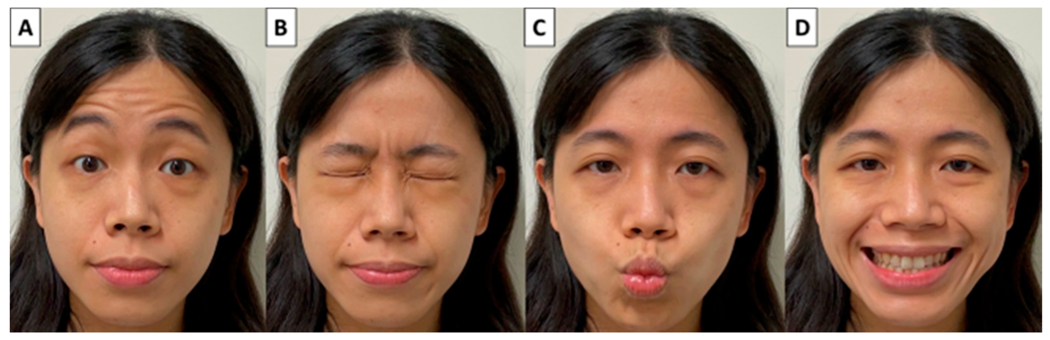 Proposals for Standardization of Intraoperative Facial Nerve Monitoring ...