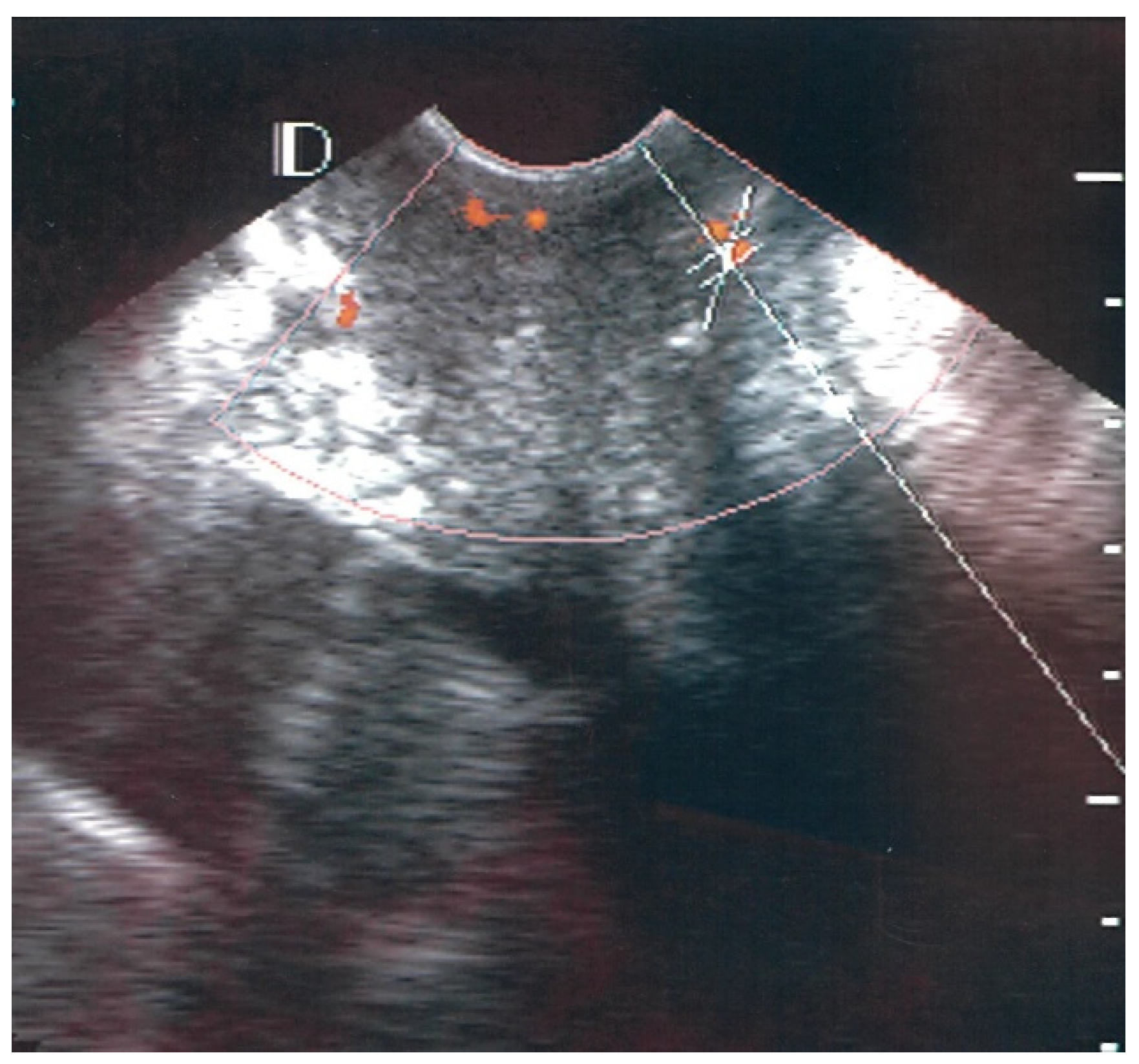 Classification of Vascular Hotspots and Micro-Vessel Flow Velocity ...