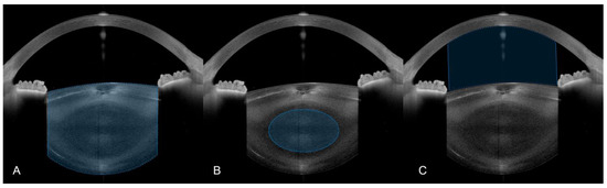 Automatic Quantitative Assessment of Lens Opacities Using Two Anterior ...