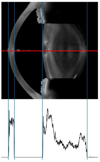 Automatic Quantitative Assessment of Lens Opacities Using Two Anterior ...