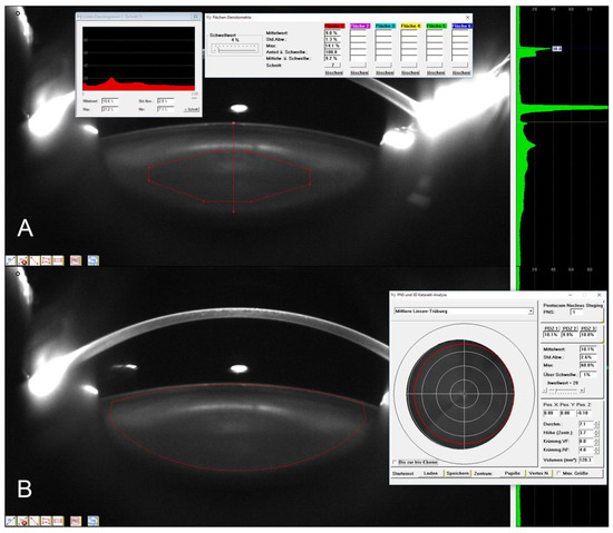 Automatic Quantitative Assessment of Lens Opacities Using Two Anterior Segment Imaging ...