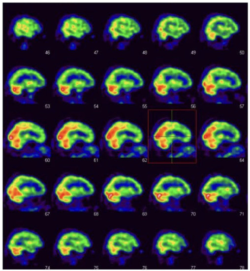 The Assessment of Subregions in the Frontal Lobe May Be Feasible in the ...