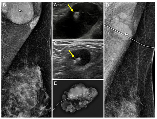 Comparison of the Ultrasound Visibility of Tissue Markers in Metastatic ...