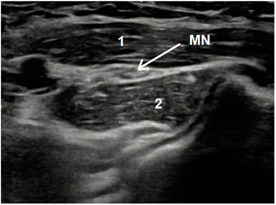 How to Differentiate Pronator Syndrome from Carpal Tunnel Syndrome: A ...