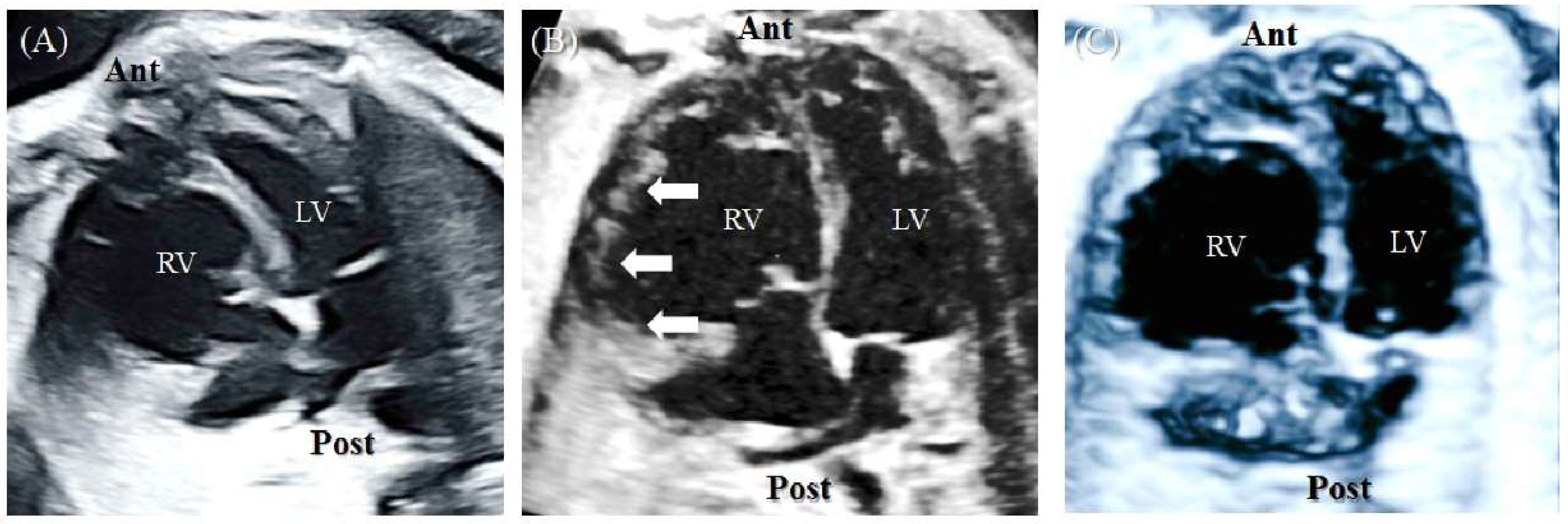 Prenatal Diagnosis of Right-Sided Congenital Ventricular Diverticulum ...