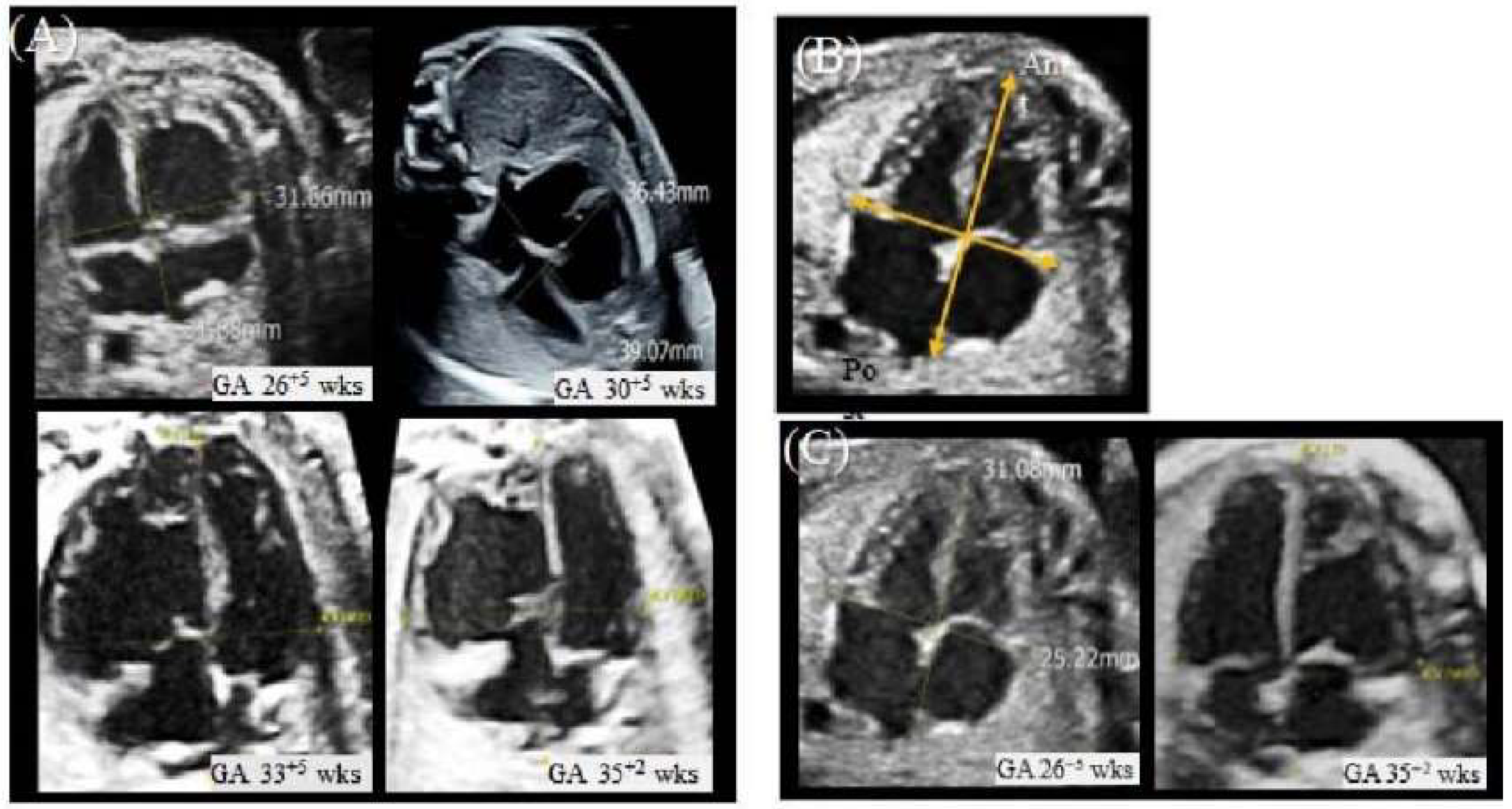 Prenatal Diagnosis of Right-Sided Congenital Ventricular Diverticulum ...