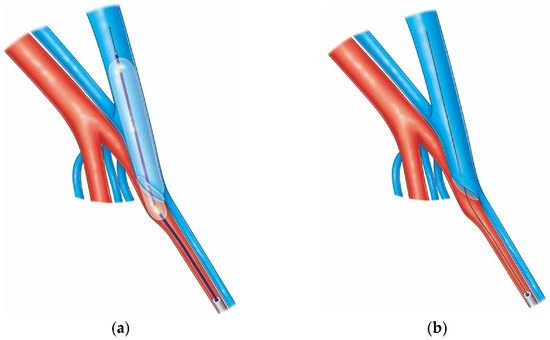 Endovascular Arteriovenous Fistula Creation—Review of Current Experience