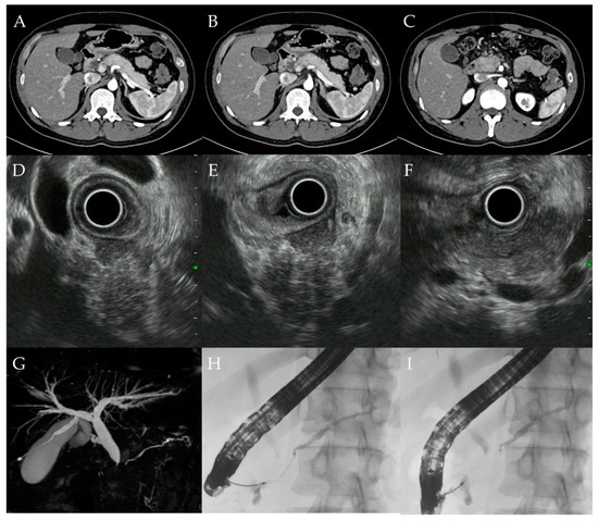 Utility of Endoscopic Ultrasound-Guided Fine-Needle Aspiration and ...