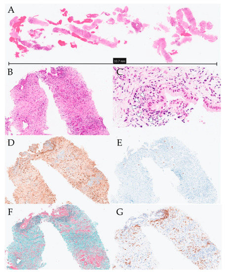 Utility of Endoscopic Ultrasound-Guided Fine-Needle Aspiration and ...