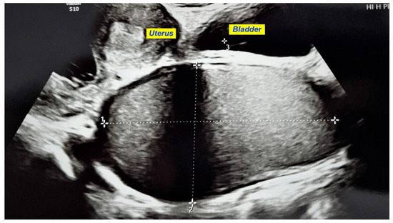 Herlyn-Werner-Wunderlich Syndrome: Case Report and Review of the Literature
