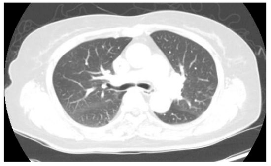 Septic Pulmonary Emboli Detected by 18F-FDG PET/CT in a Patient with ...