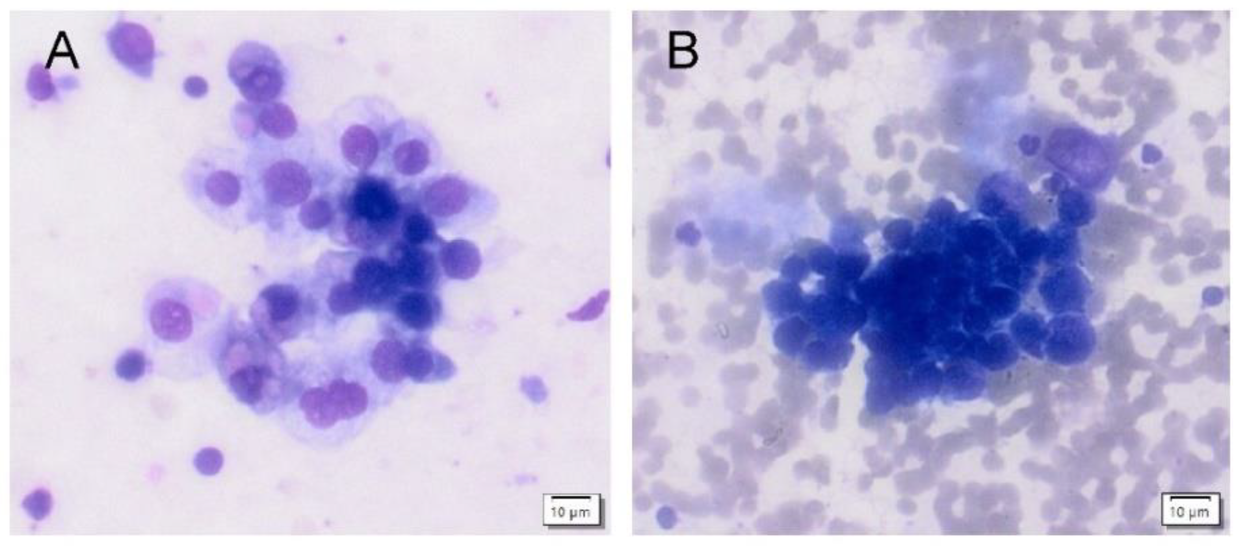 Transitional Cell Carcinoma Cytology