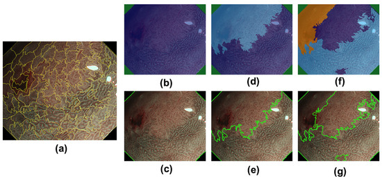 Demarcation Line Determination for Diagnosis of Gastric Cancer Disease ...