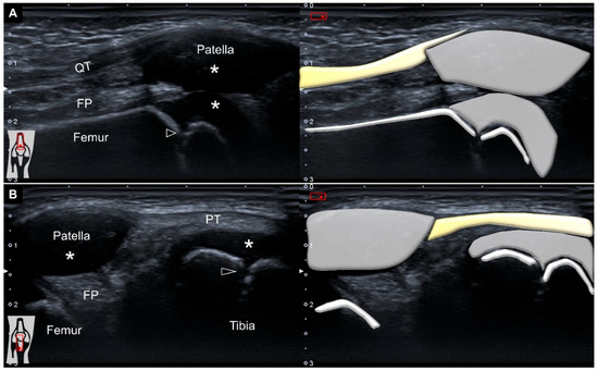 Dynamic Ultrasonography for Imaging Pediatric Fat Pad Herniation ...