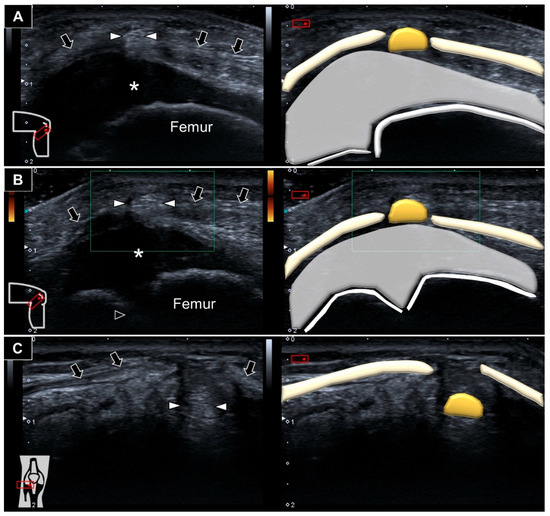Dynamic Ultrasonography for Imaging Pediatric Fat Pad Herniation ...