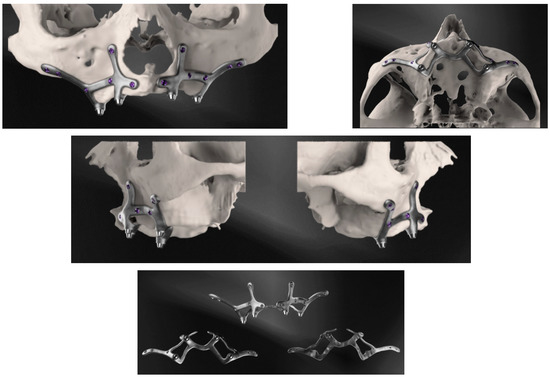 Custom-Made Direct Metal Laser Sintering Titanium Subperiosteal ...
