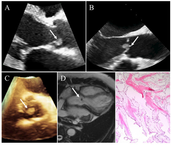 Multimodality Imaging of Benign Primary Cardiac Tumor