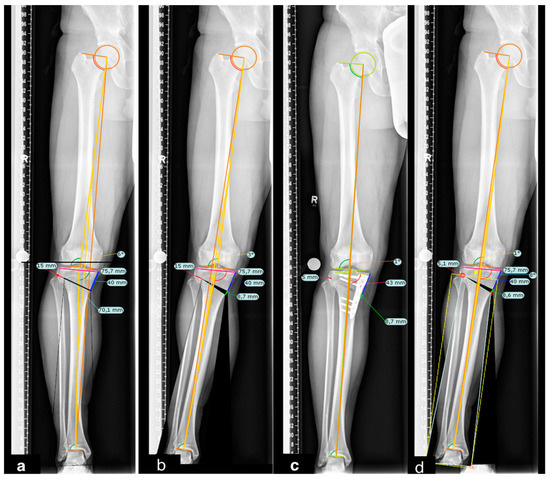 Influence of Medial Osteotomy Height and Hinge Position in Open Wedge ...
