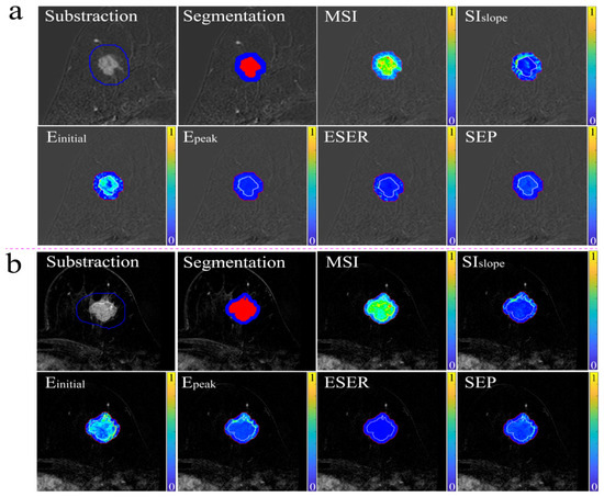Multiregional Radiomic Signatures Based on Functional Parametric Maps ...