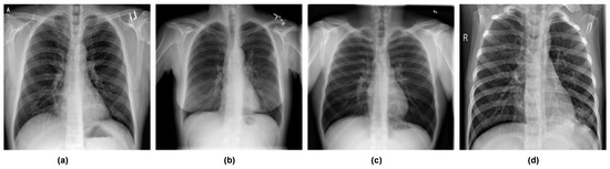 EVAE-Net: An Ensemble Variational Autoencoder Deep Learning Network for COVID-19 Classification ...
