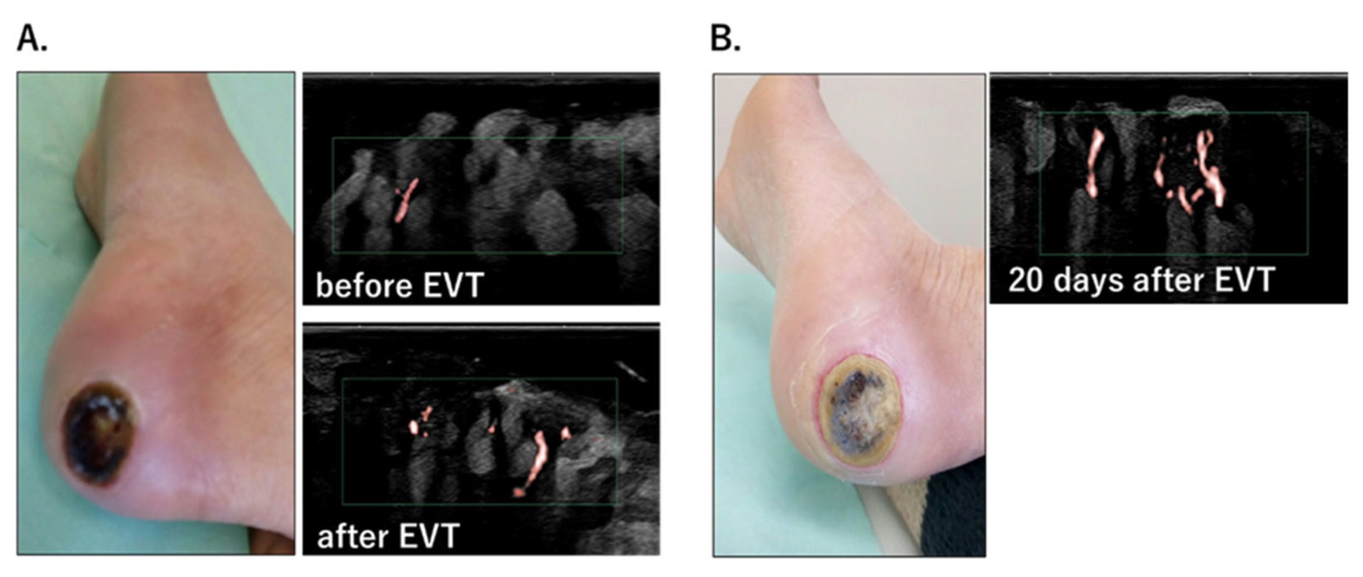 Utility of Superb Microvascular Imaging in the Assessment of Foot ...