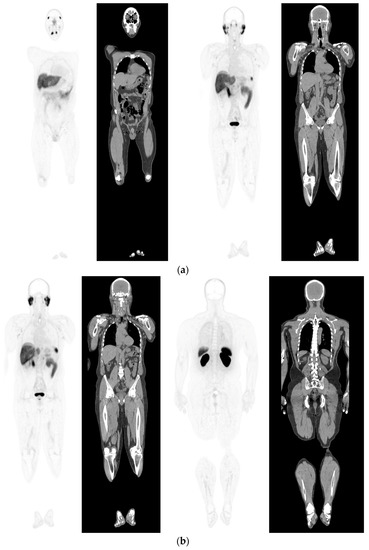 PSMA PET-CT in the Diagnosis and Staging of Prostate Cancer