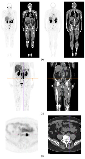 PSMA PET-CT in the Diagnosis and Staging of Prostate Cancer