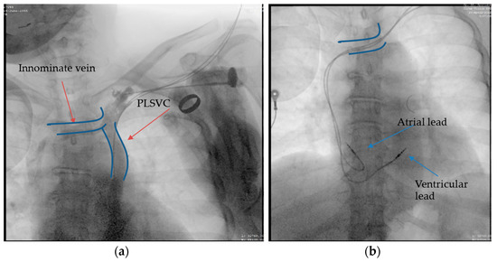 Cardiac Implantable Electronic Devices in Different Anatomical Types of ...