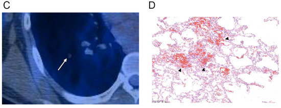 Solitary Pulmonary Capillary Hemangioma: CT and PET-CT Features with ...