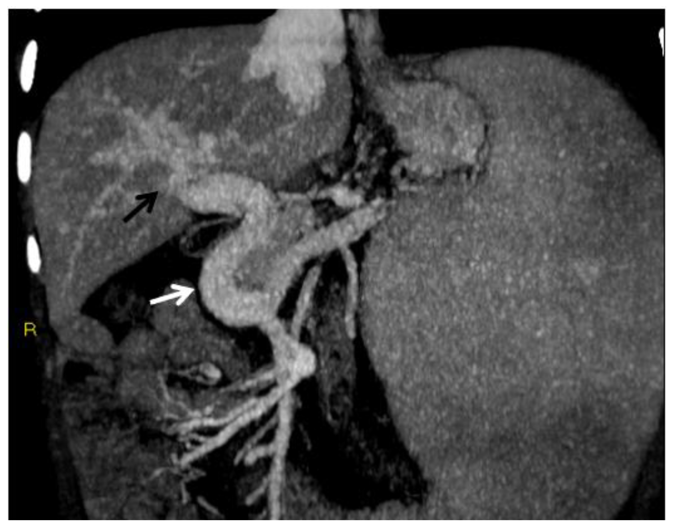 Portal Vein Thrombosis