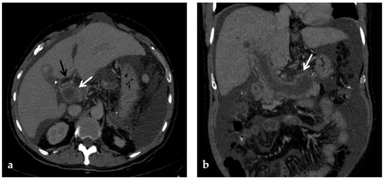 The Role of Imaging in Portal Vein Thrombosis: From the Diagnosis to ...