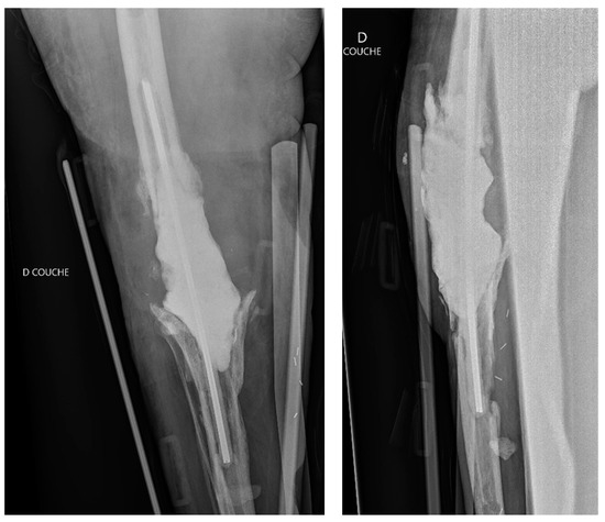 Prosthetic Knee Joint Infection Due to Candida lusitaniae: A Diagnostic ...