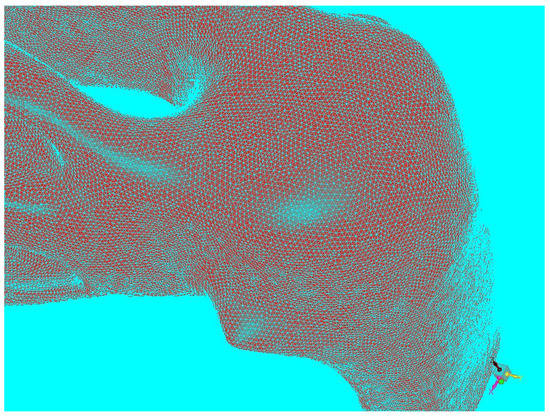 Computational Fluid Dynamics Could Enable Individualized Surgical ...