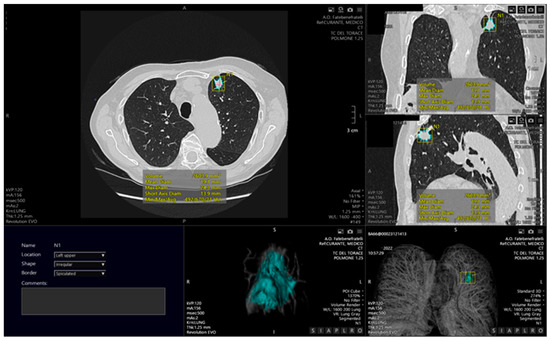 Artificial Intelligence in Lung Cancer Imaging: Unfolding the Future
