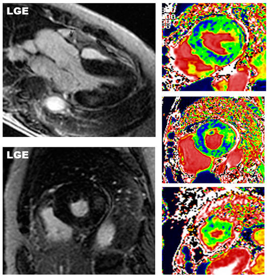 Cardiac Magnetic Resonance in Fabry Disease: Morphological, Functional ...