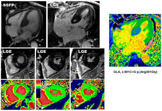 Cardiac Magnetic Resonance in Fabry Disease: Morphological, Functional ...