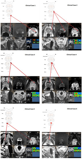 Are Urologists Ready for Interpretation of Multiparametric MRI Findings ...